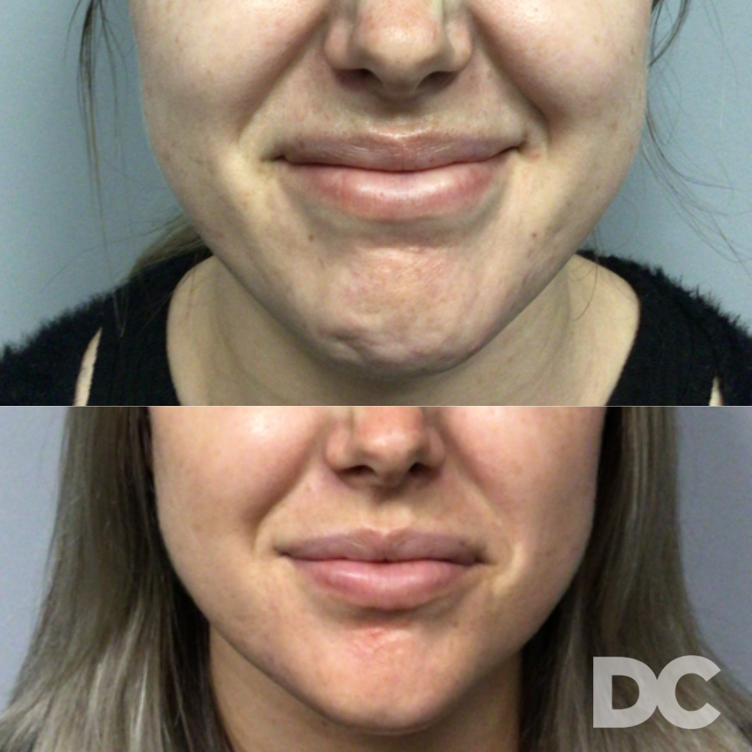 Botox® Dysport® Nuceiva™ Xeomin® Winnipeg