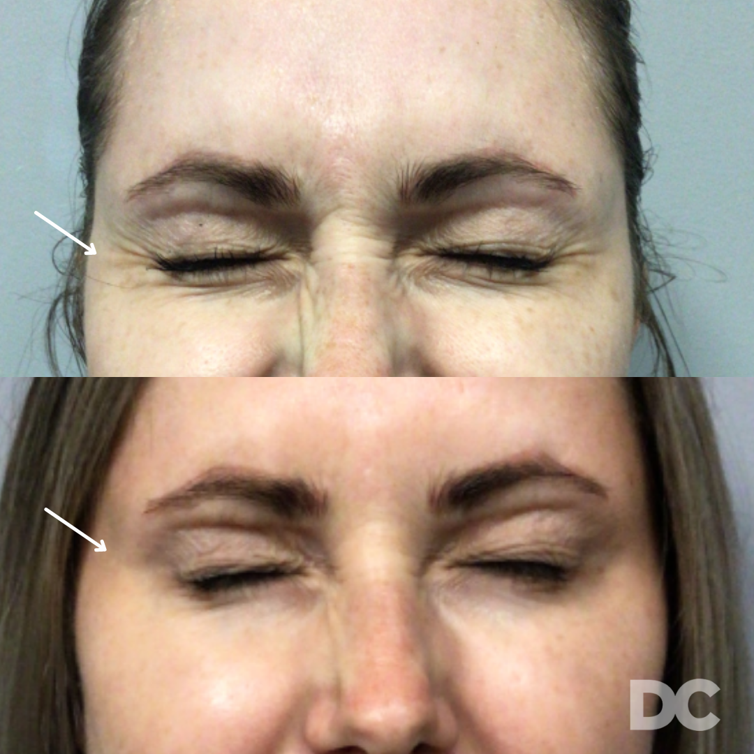 Botox® Winnipeg Victoria Park Medispa The Derm Centre