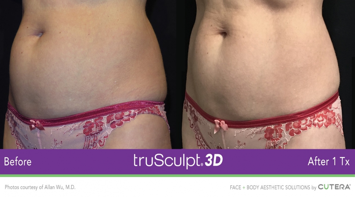 Trusculpt® 3d Fat Reduction Body Contouring Winnipeg The De