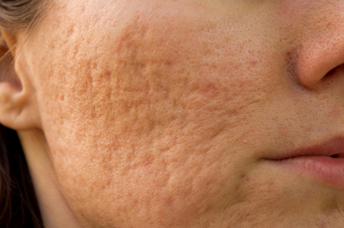 Acne Scars | Winnipeg | Victoria Park Medispa (The Derm Centre) Acne Scars | Winnipeg | Victoria Park Medispa (The Derm Centre)