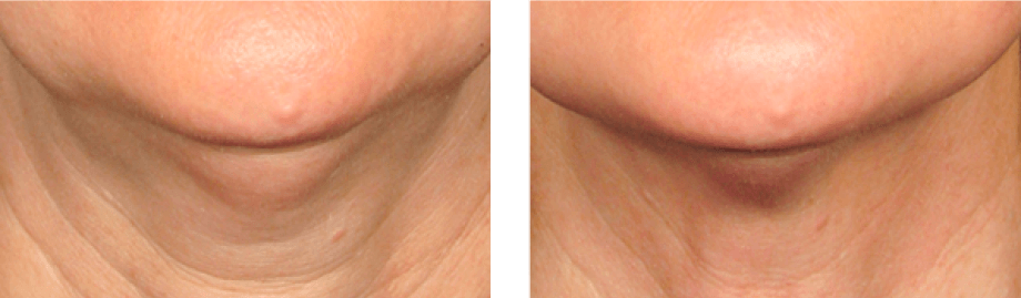 Ultherapy Skin Tightening Winnipeg Victoria Park Medispa The Derm
